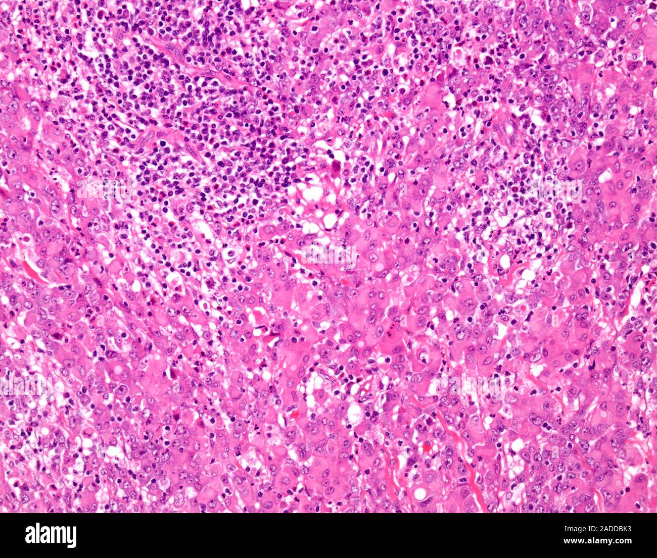 Colon cancer due to genetic mutation, light micrograph. This specimen ...