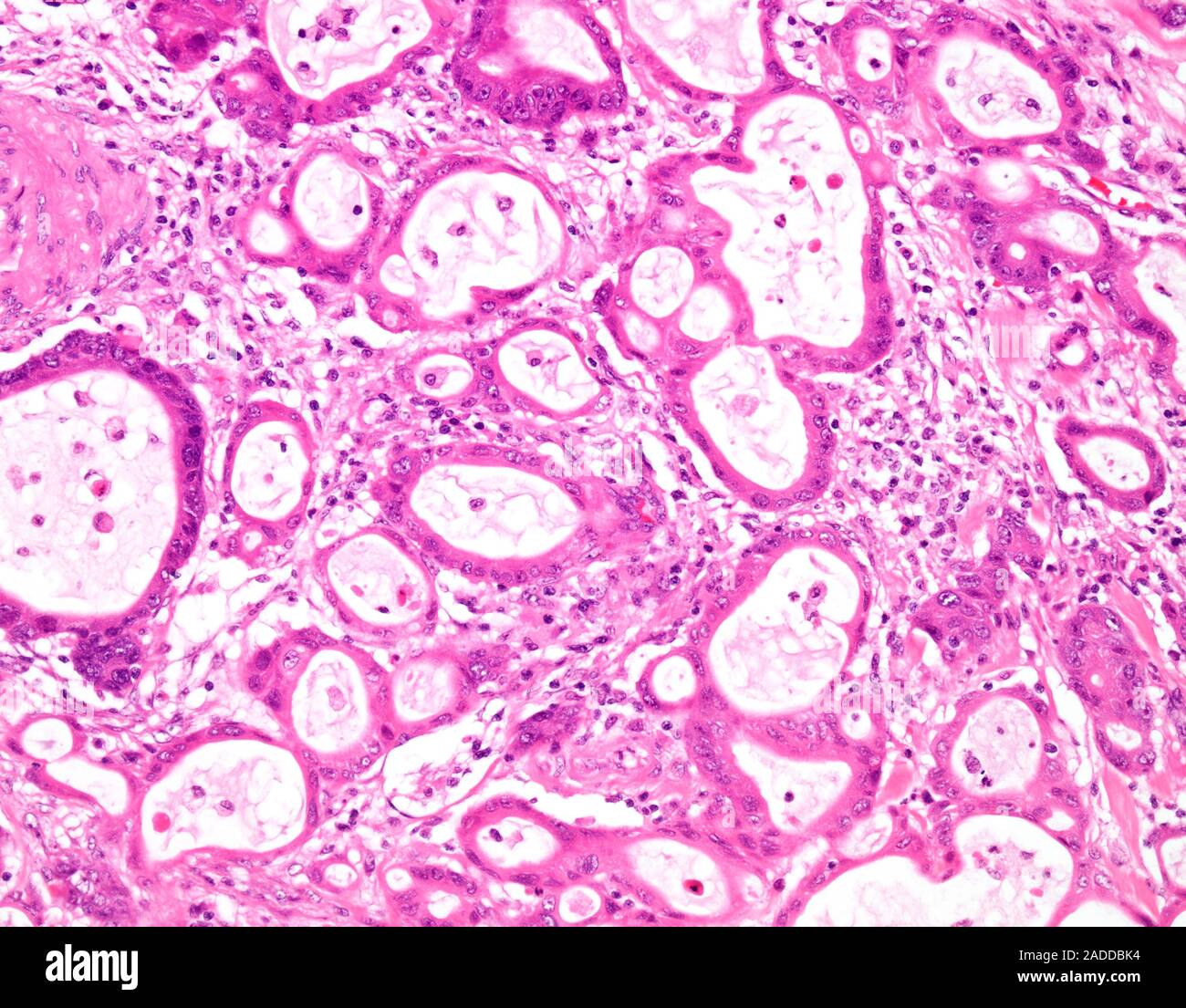 Colon cancer due to genetic mutation, light micrograph. This specimen ...
