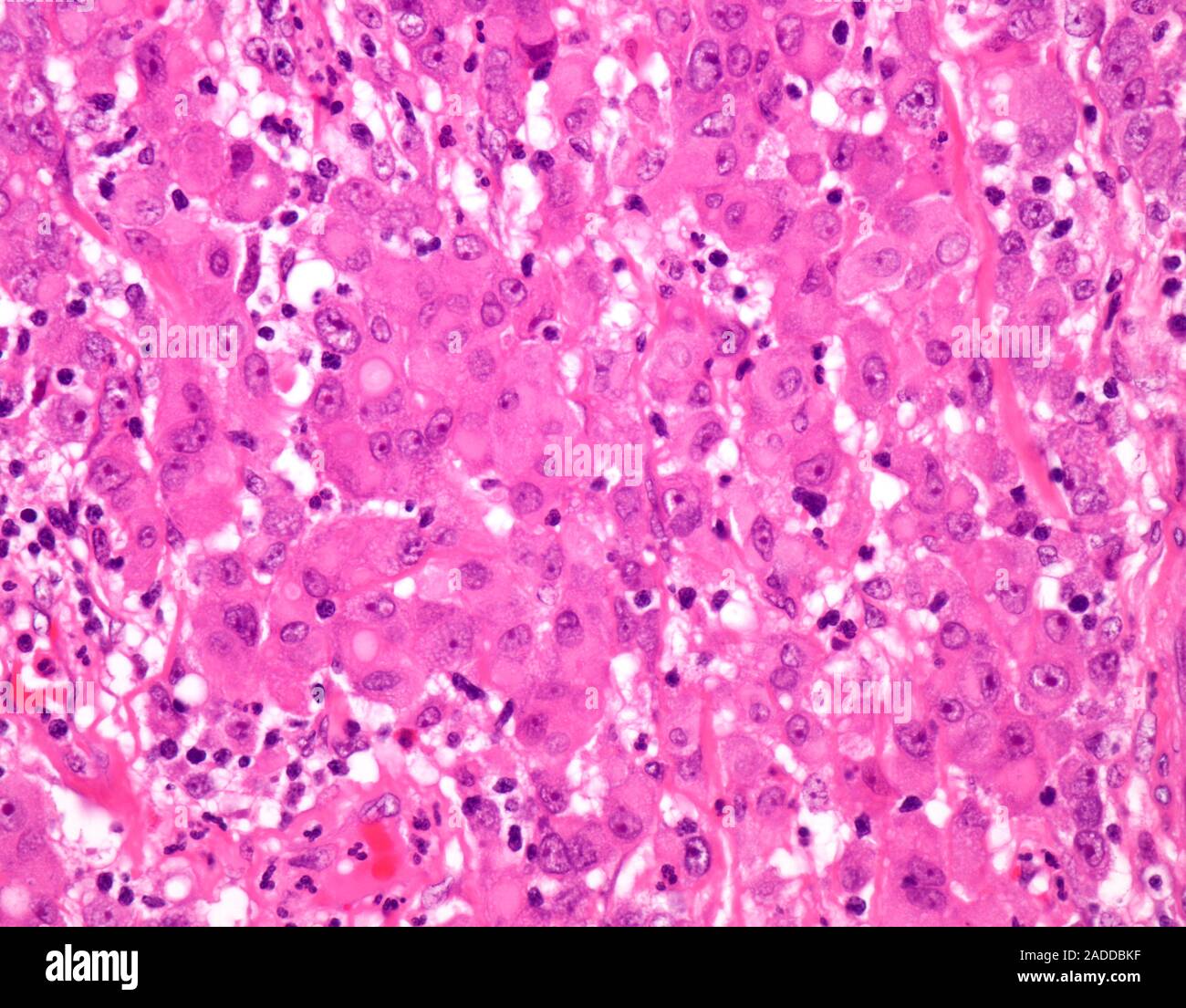 Colon cancer due to genetic mutation, light micrograph. This specimen ...