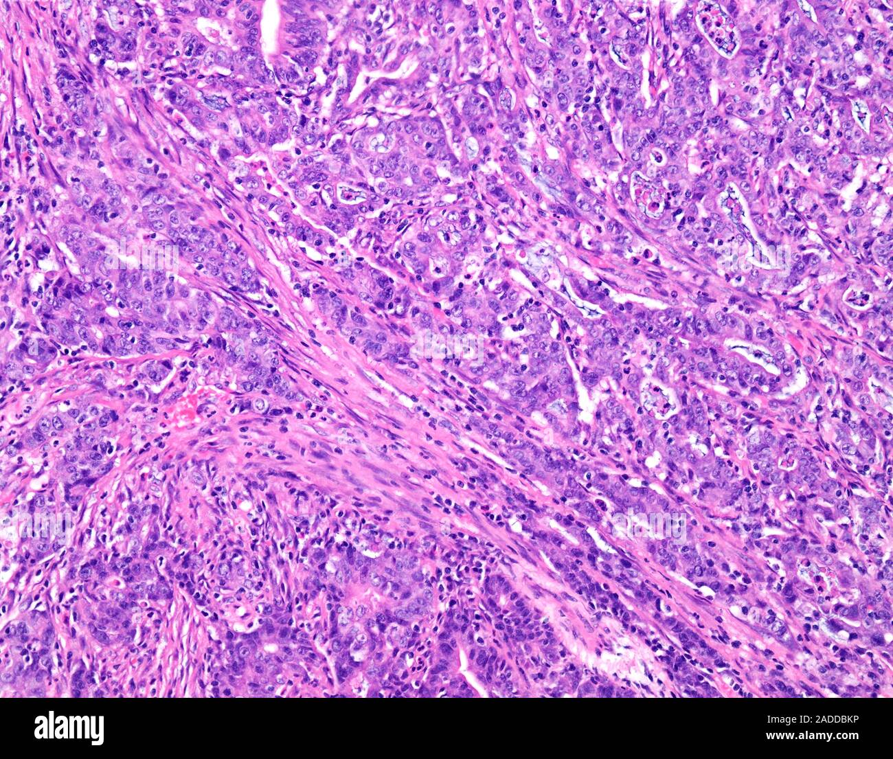 Colon cancer due to genetic mutation, light micrograph. This specimen ...