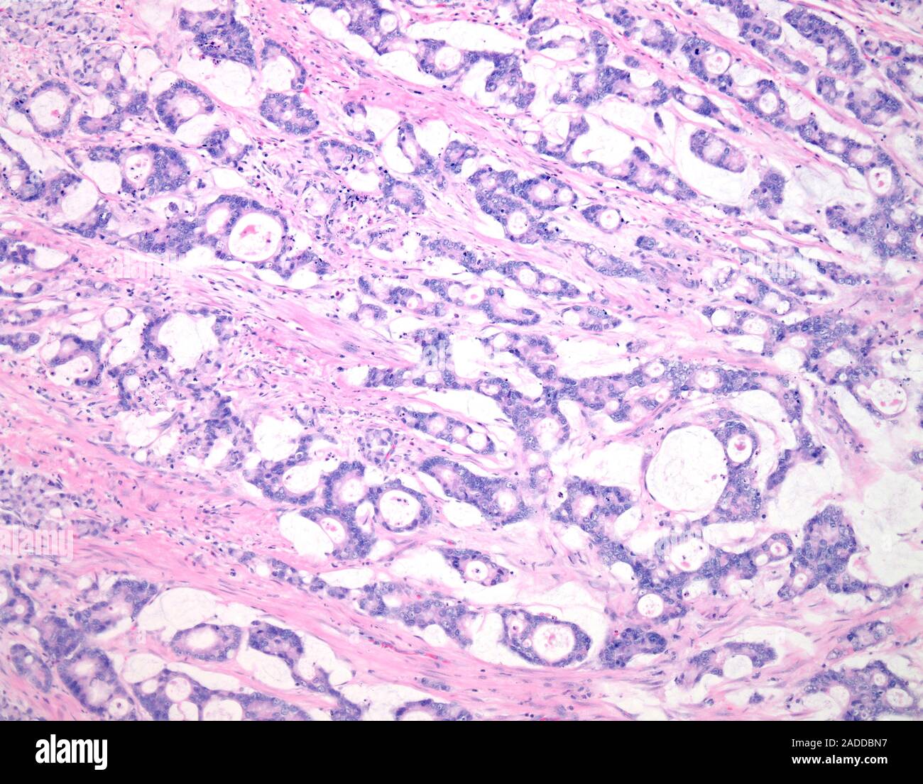 Mucinous carcinoma of the colon, light micrograph. This is a type of ...