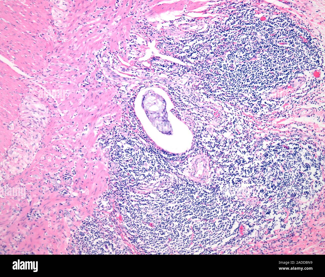 Colon cancer and lymph tissue, light micrograph. This is a form of ...