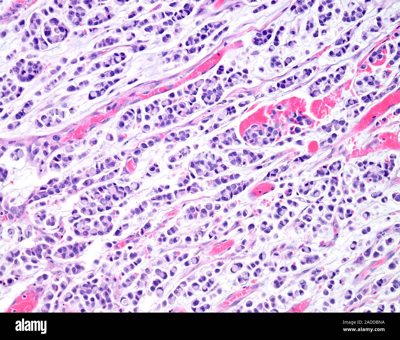 Signet ring cell carcinoma of the colon, light micrograph. This is a ...