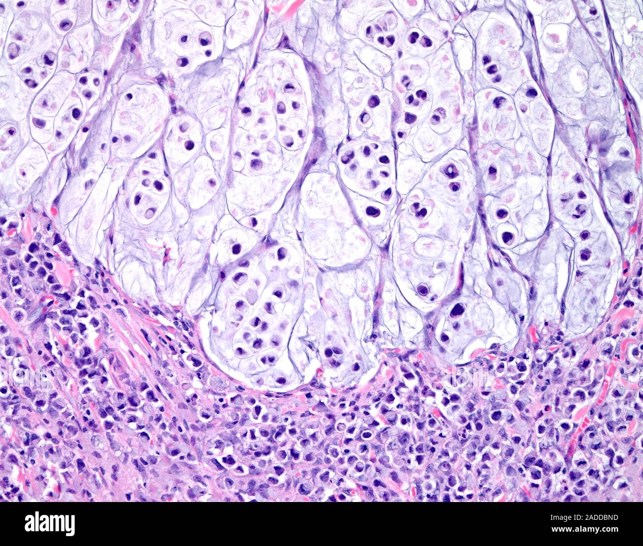 Signet ring cell carcinoma of the colon, light micrograph. This is a ...