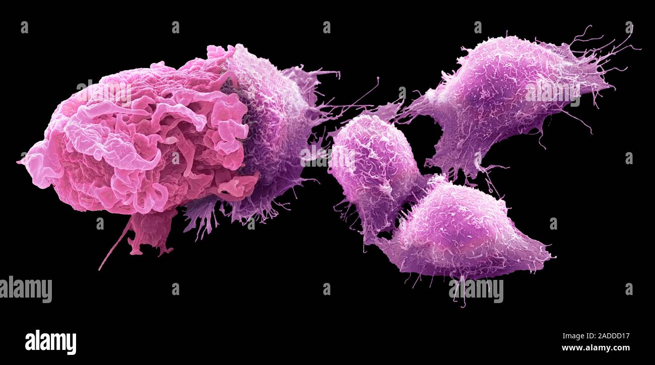 Macrophage (far left) and cancer cells (centre and right), composite ...