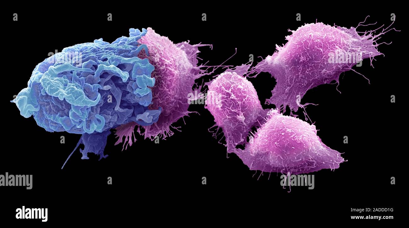 Macrophage (blue) and cancer cells (pink), composite coloured scanning electron micrograph (SEM ...
