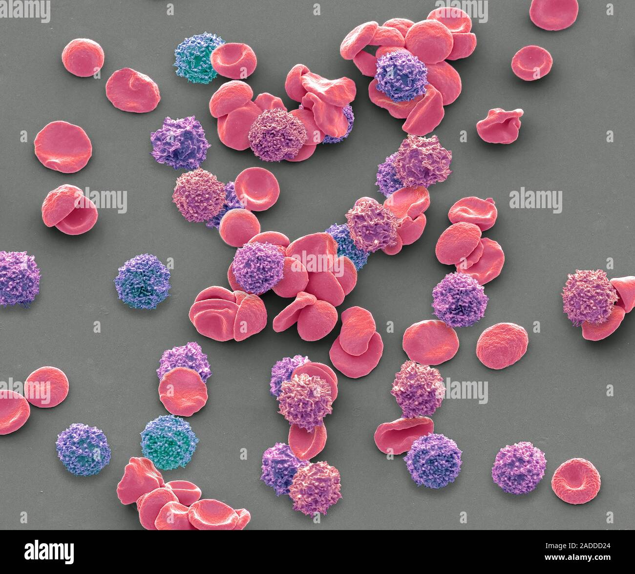 Leukaemia blood cells. Composite coloured scanning electron micrograph ...