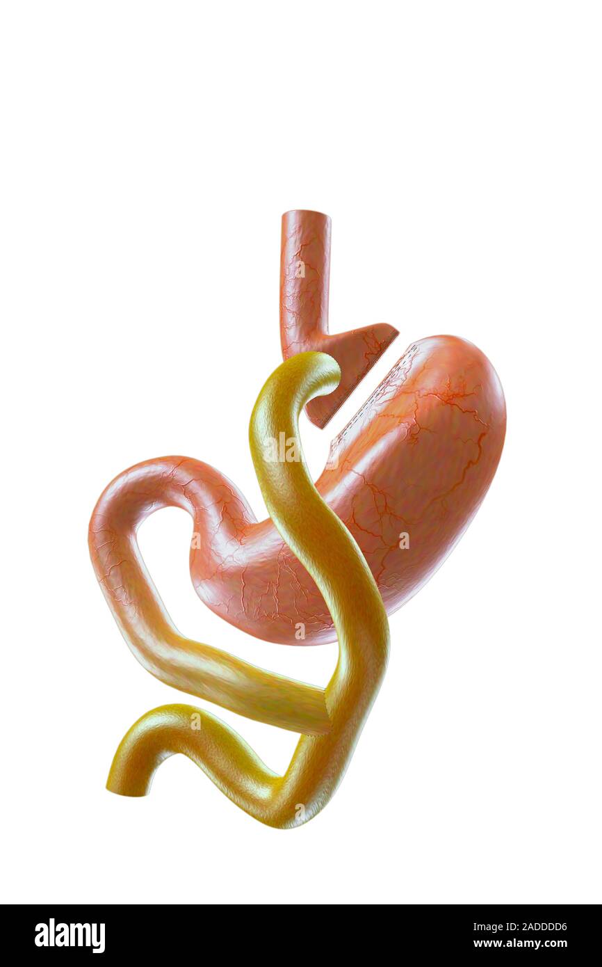 Gastric bypass. Computer illustration of a human stomach following ...