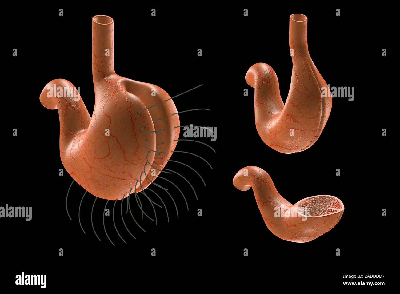 Gastric plication surgery. Computer illustration of a human stomach ...