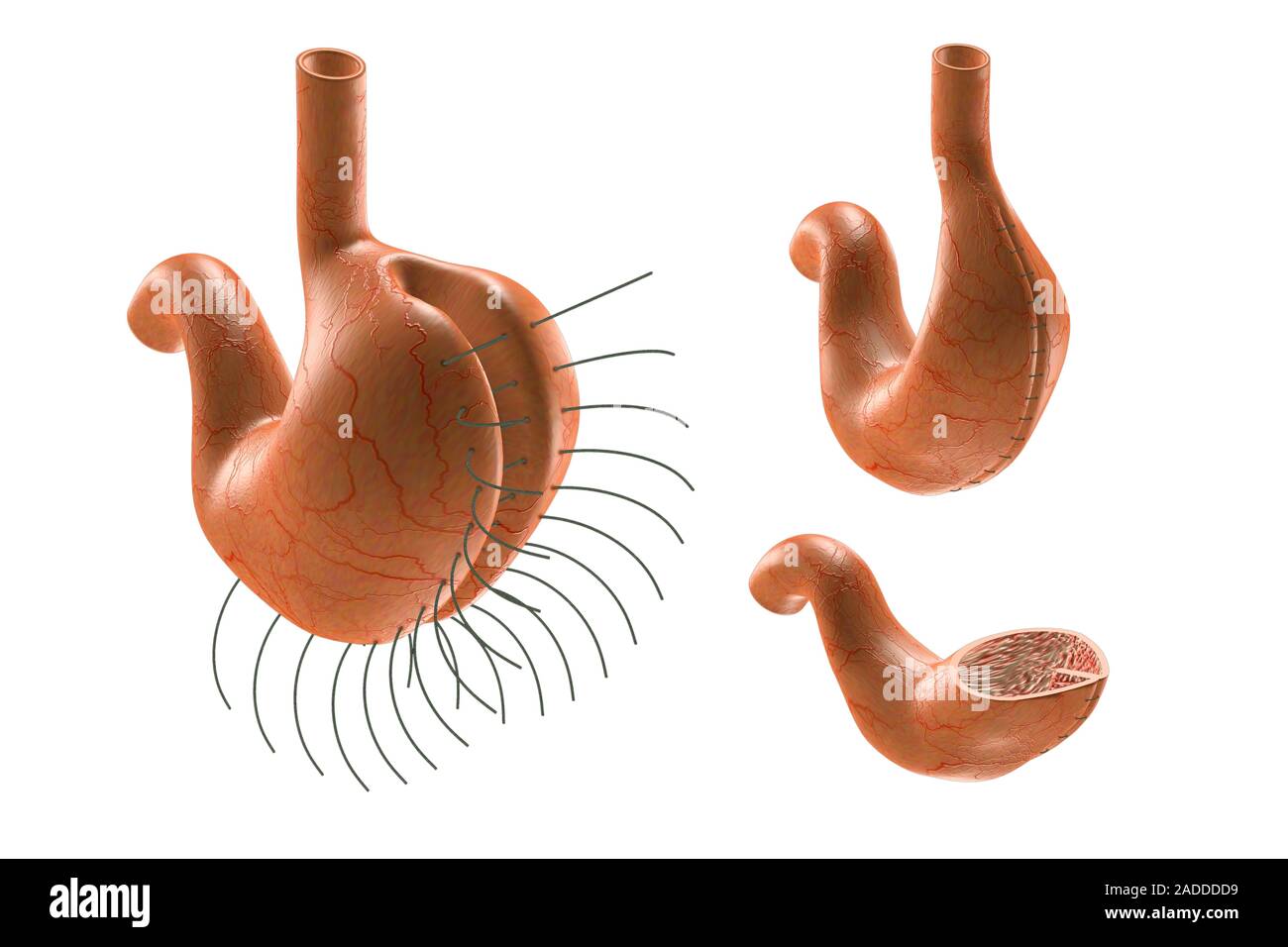 Gastric plication surgery. Computer illustration of a human stomach ...