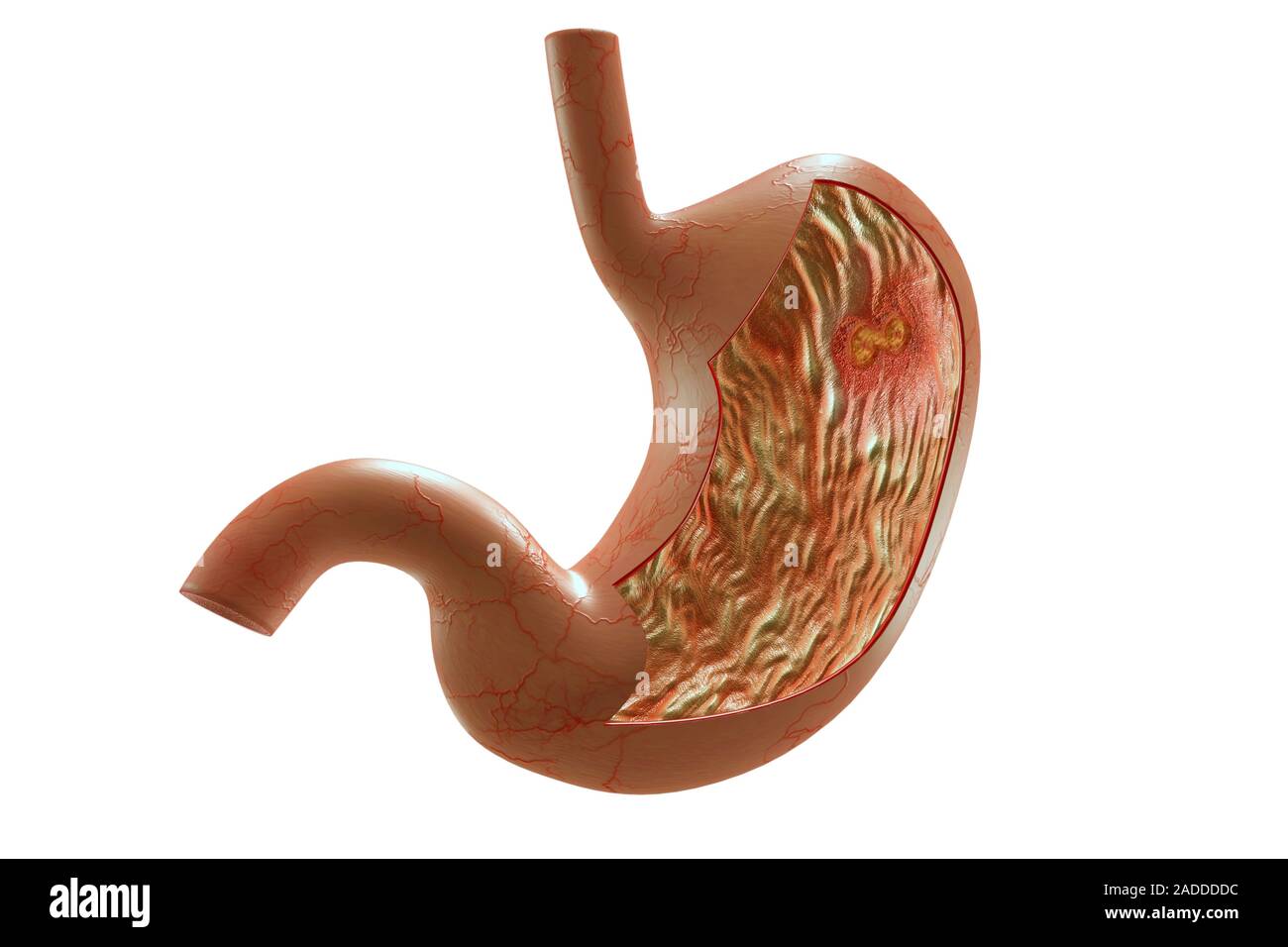Stomach ulcer. Computer illustration of a section through a human ...