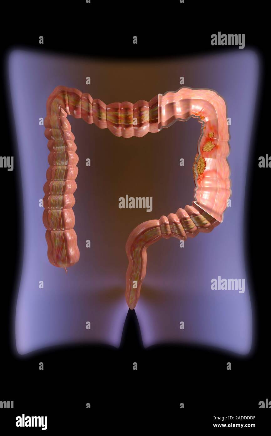 Colon cancer. Computer illustration of a cancerous lesion (red, right ...