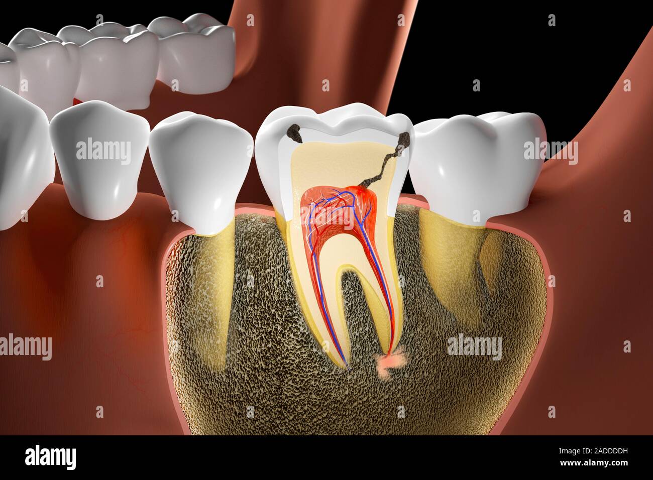 Tooth decay. Computer illustration of a section through a cavity in a ...