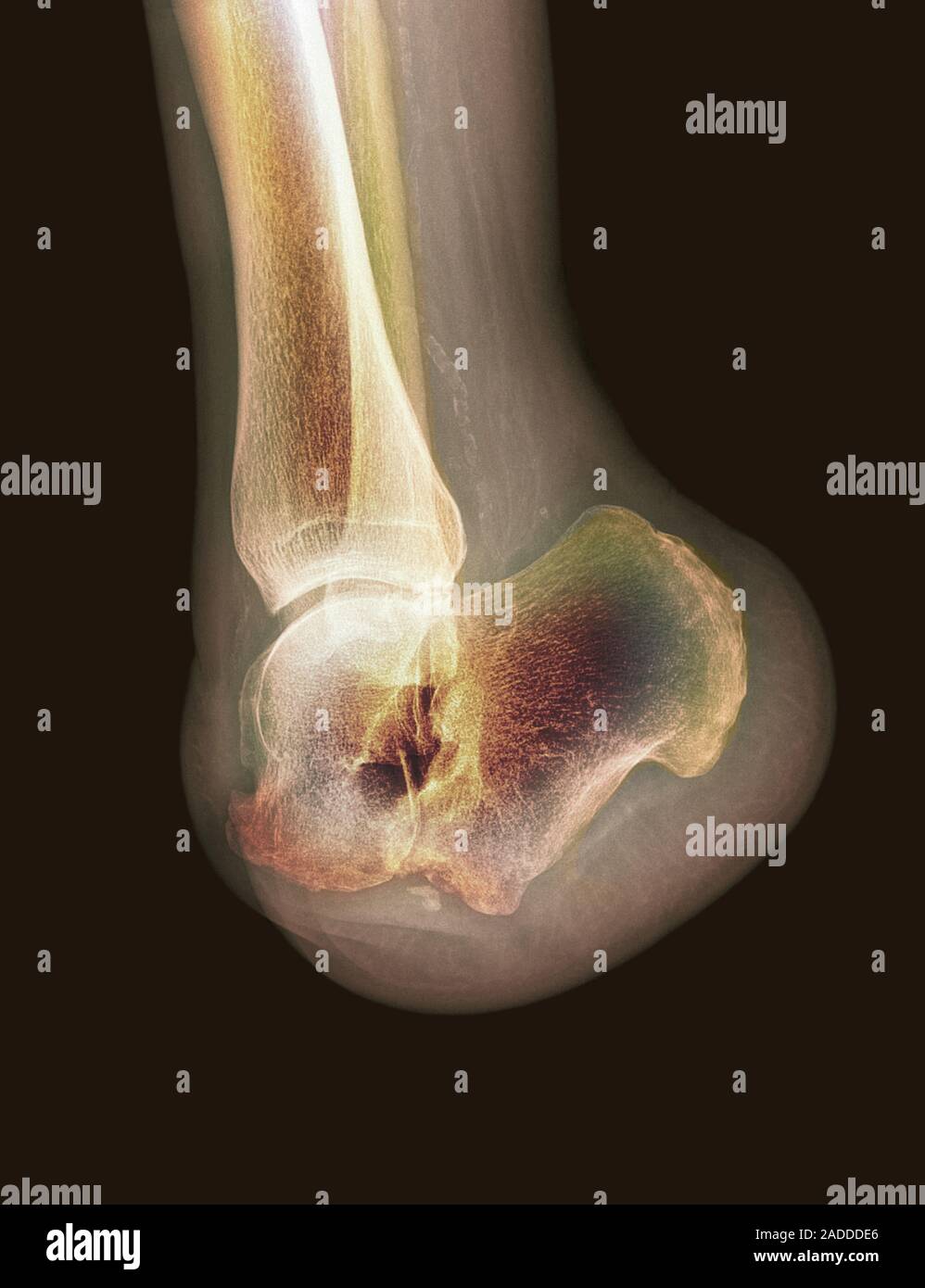 Amputated foot. Coloured X-ray of a section through the lower leg of a ...