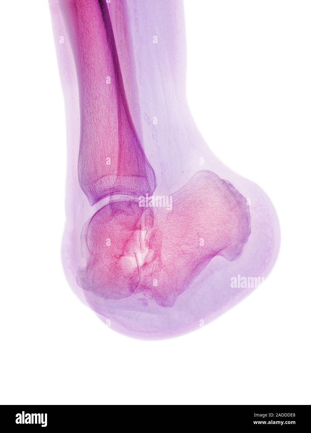 Amputated foot. Coloured X-ray of a section through the lower leg of a ...
