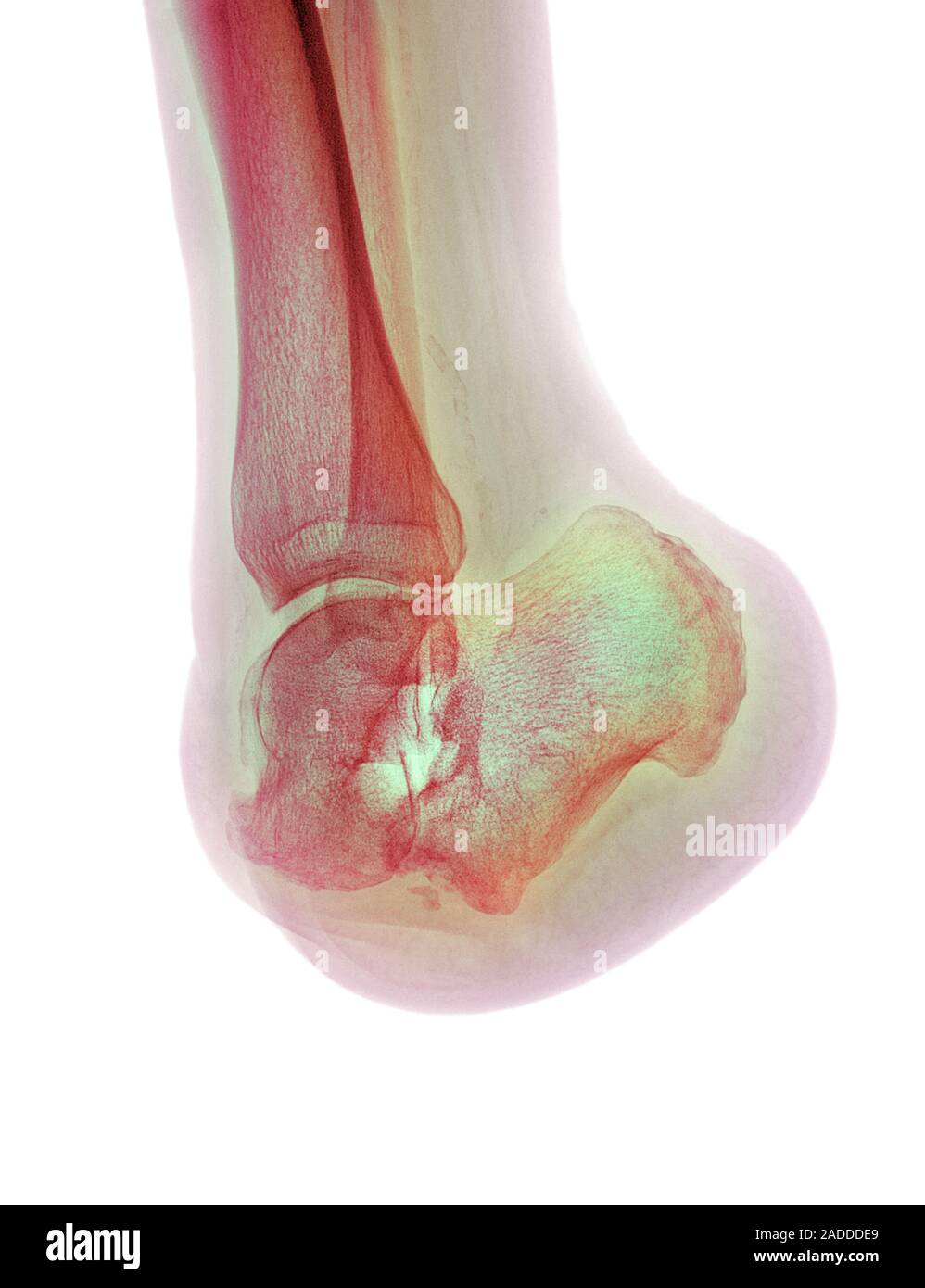 Amputated foot. Coloured X-ray of a section through the lower leg of a ...