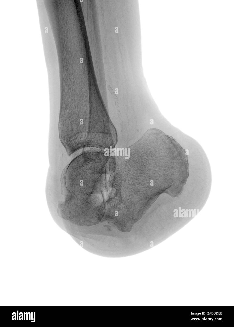 Amputated foot. X-ray of a section through the lower leg of a patient ...
