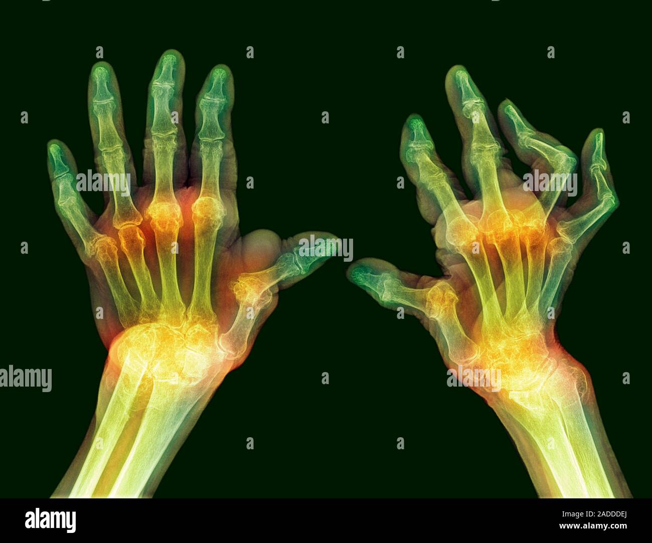 Rheumatoid Arthritis Of The Hands Coloured Bilateral X Ray Of The Hands And Wrists Of A Patient