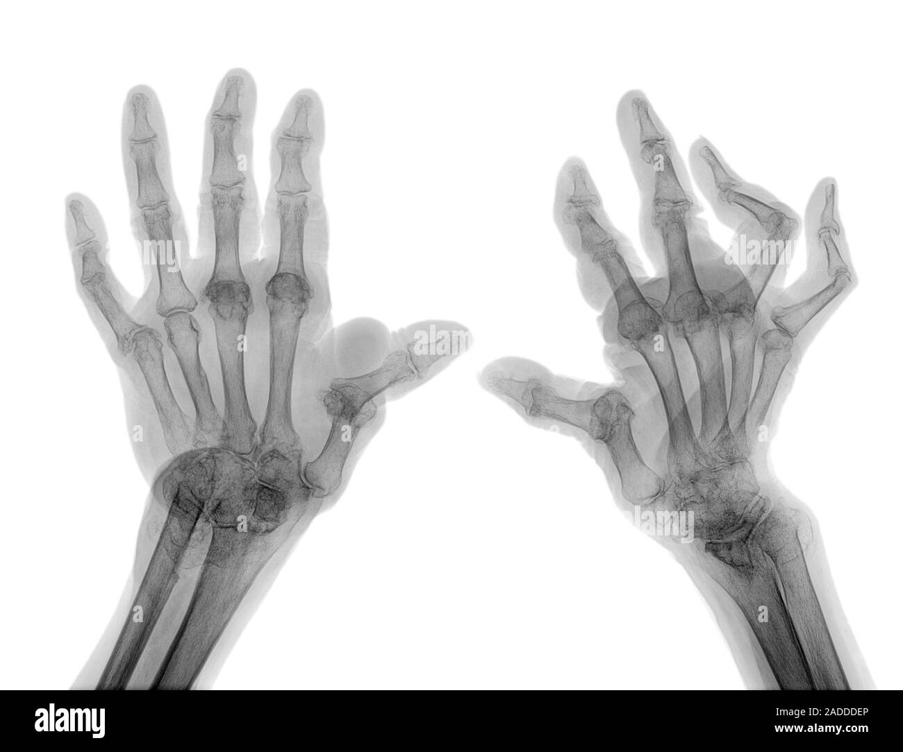 Rheumatoid arthritis of the hands. Bilateral X-ray of the hands and ...