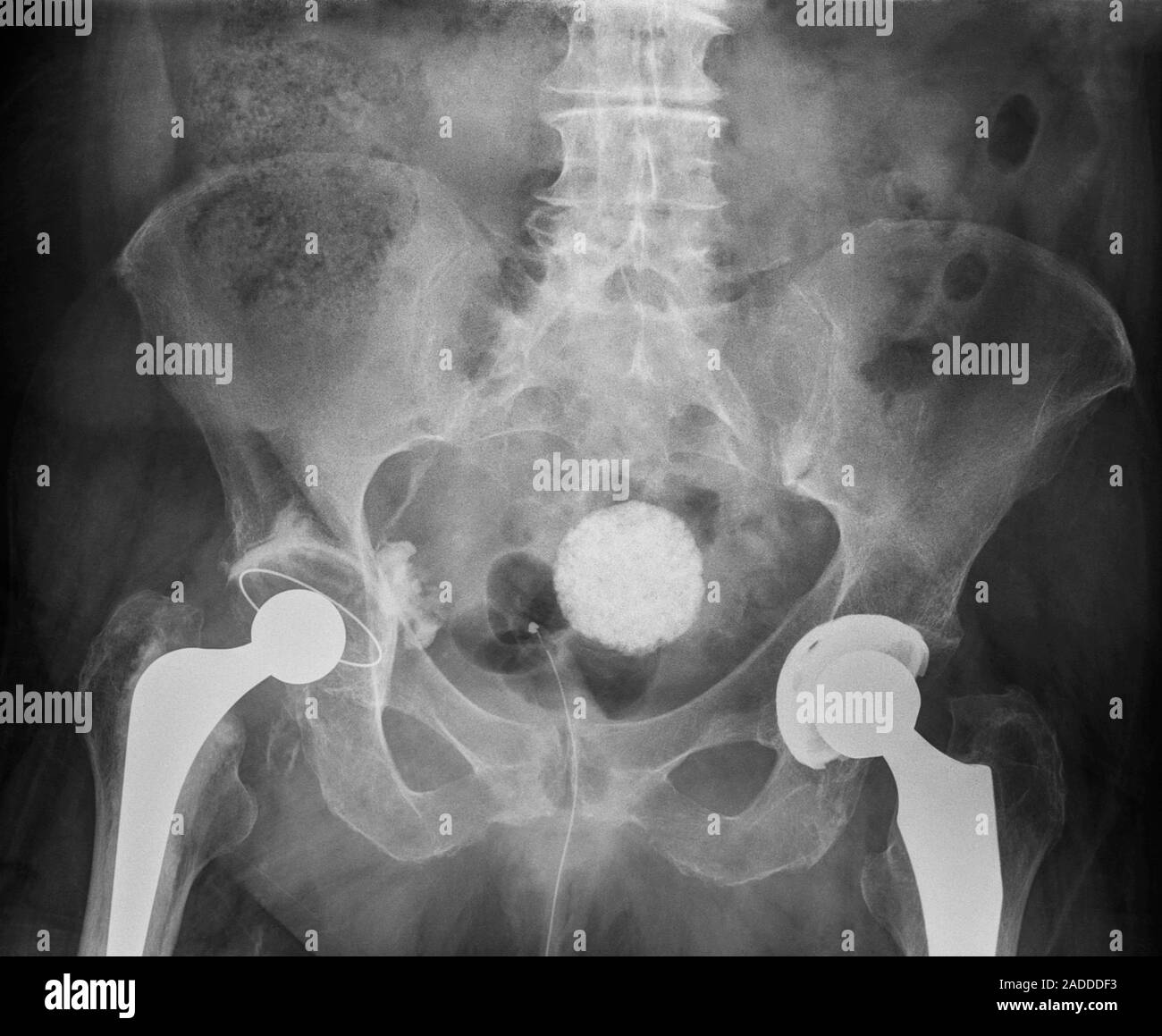 Calcified uterine fibroid. X-ray of a section through the pelvis of a ...
