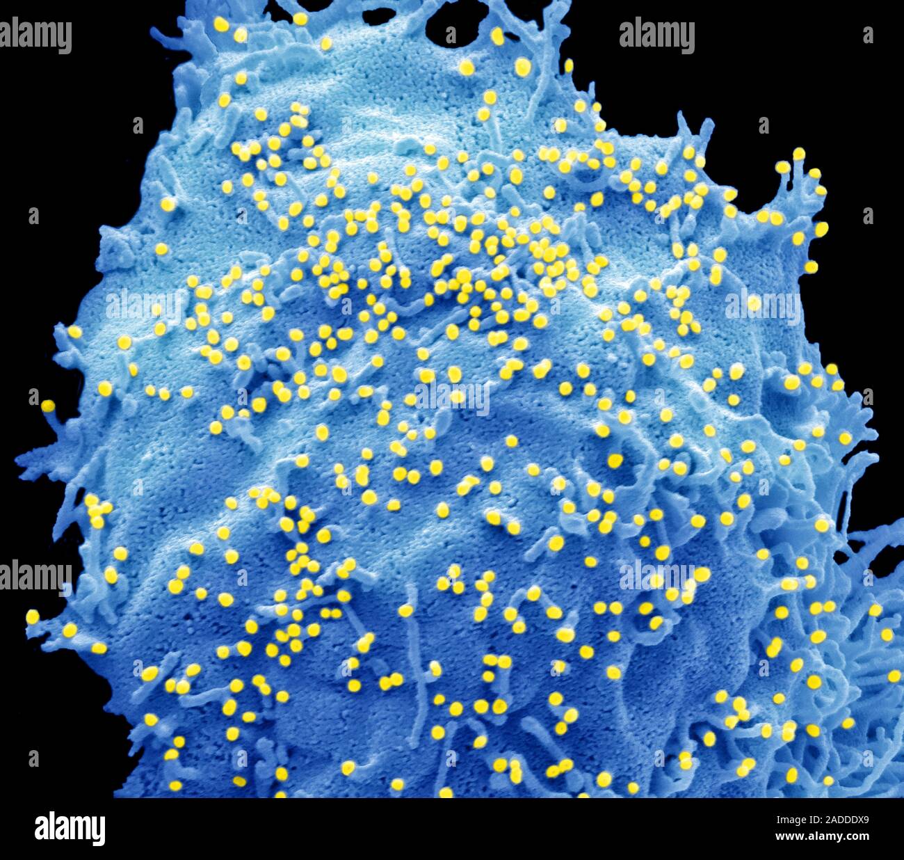 Coloured scanning electron micrograph (SEM) of human cells infected ...