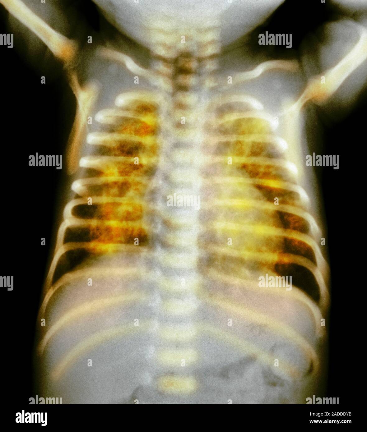 Coloured X-ray of the chest of a male infant with Wilson-Mikity ...