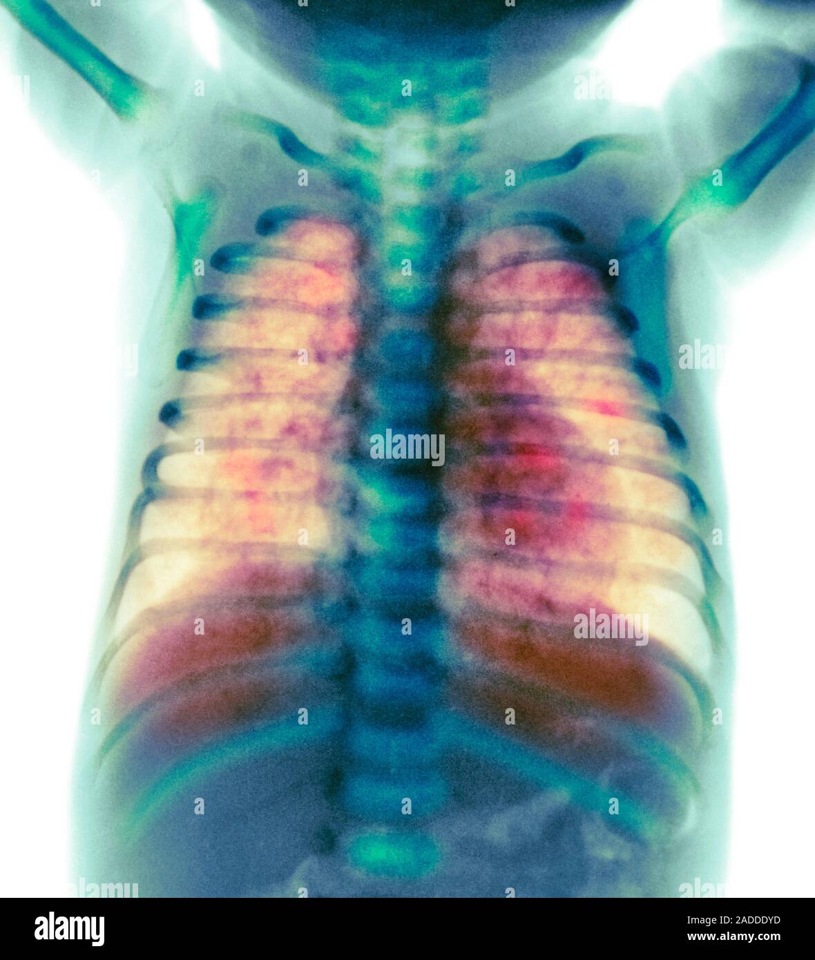 Coloured X-ray of the chest of a male infant with Wilson-Mikity ...