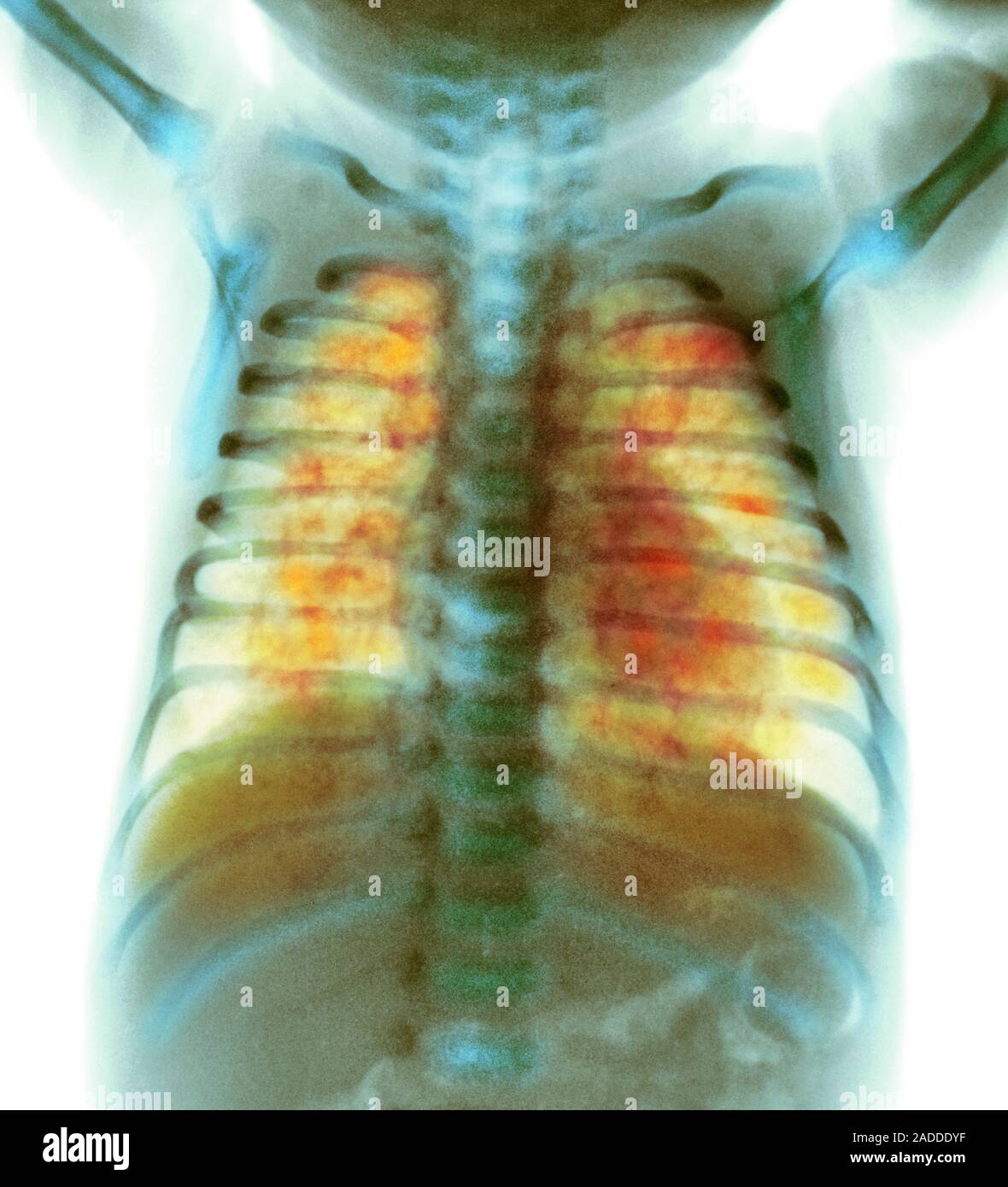 Coloured X-ray of the chest of a male infant with Wilson-Mikity ...