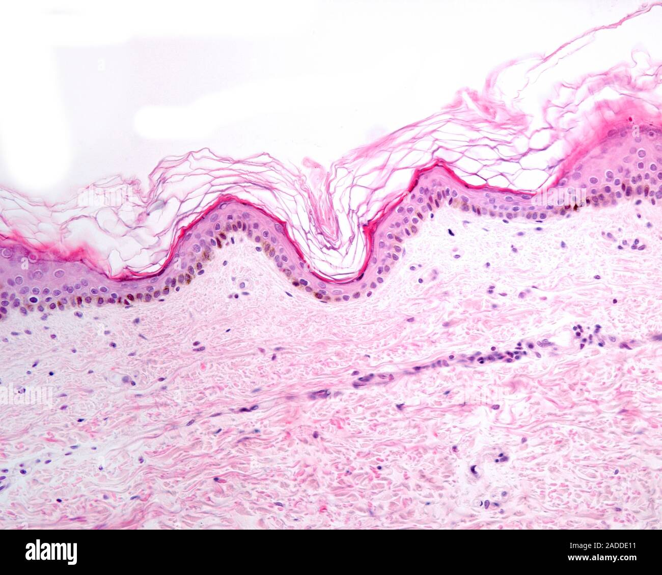 Pigmented skin, light micrograph. Brown melanin granules are seen in ...