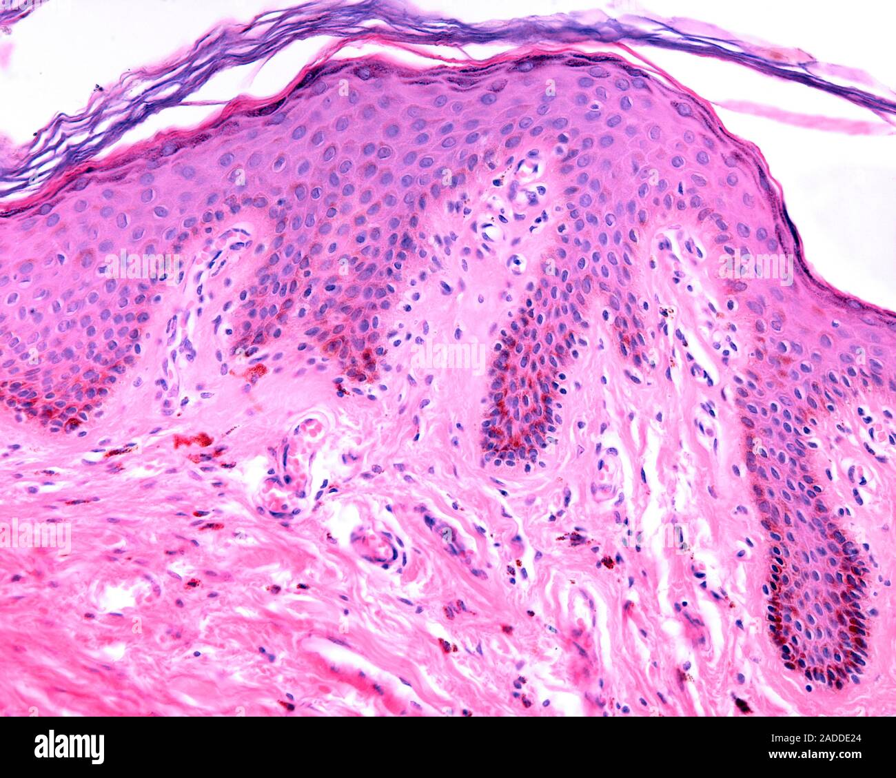Pigmented skin, light micrograph. Brown melanin granules are seen in ...