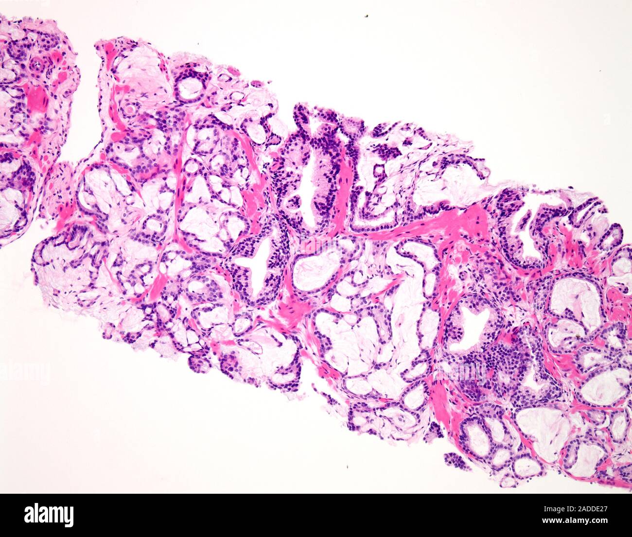 Light micrograph of mucinous variant of prostate cancer in a needle ...