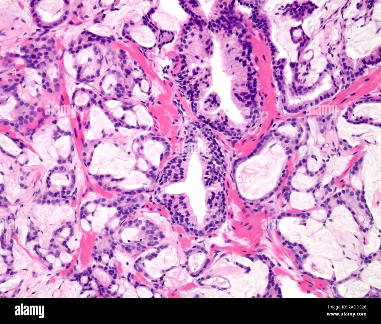 Light micrograph of mucinous variant of prostate cancer. Some of the ...