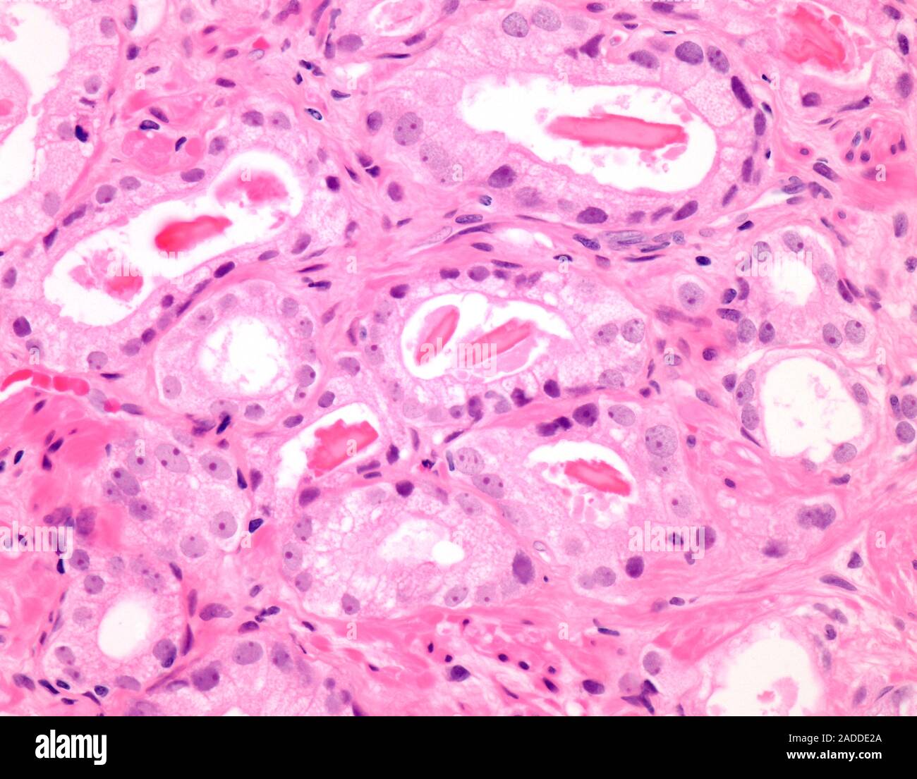 Light micrograph of prostate cancer showing intraluminal eosinophilic ...