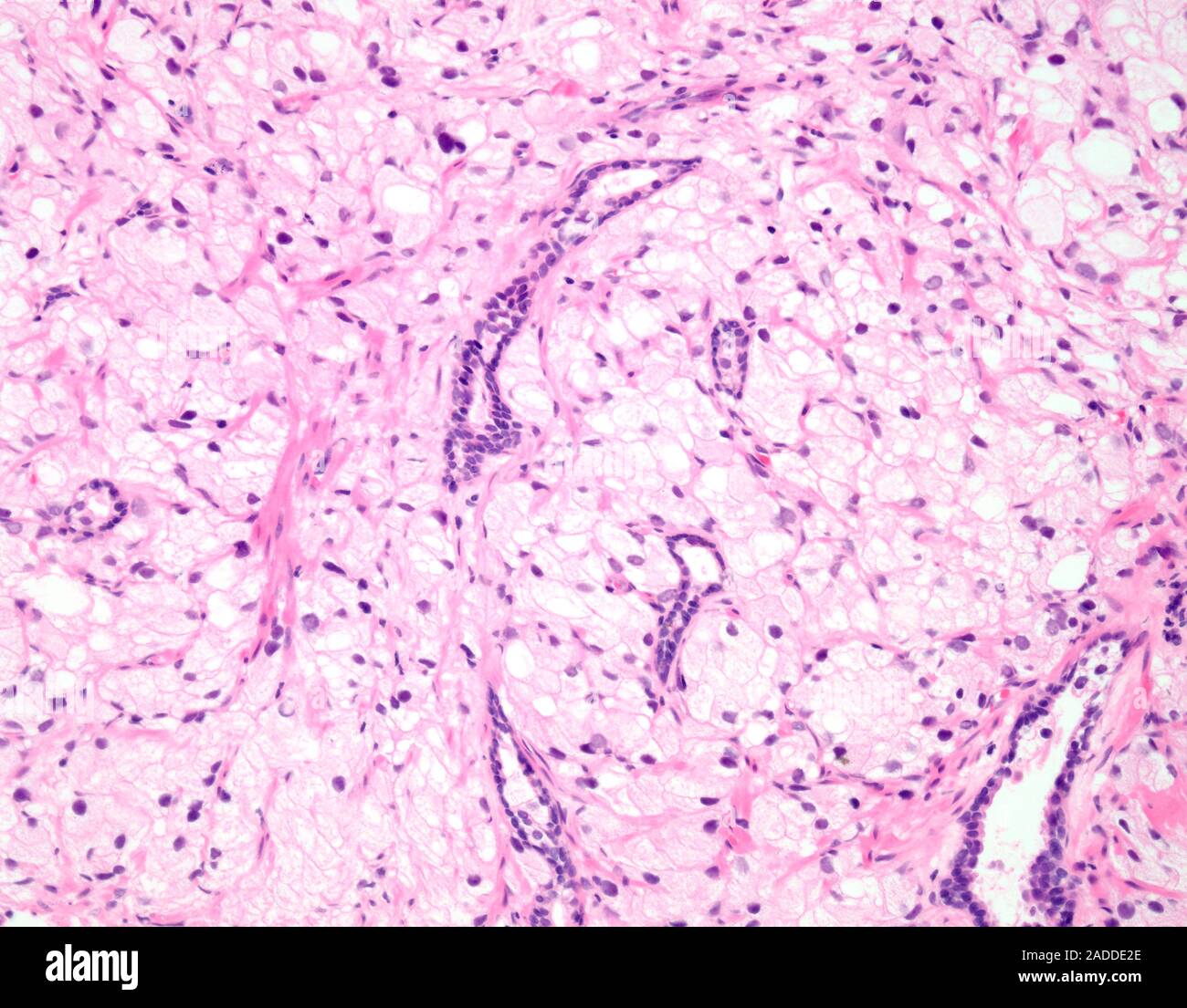 Light micrograph of prostate cancer. This is a high-grade (aggressive ...