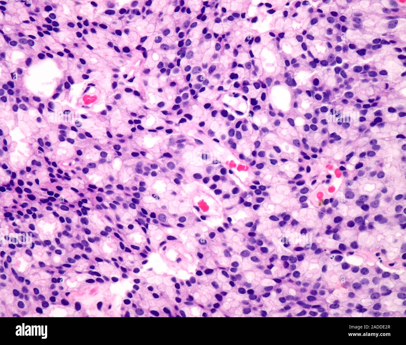 Light micrograph of prostate cancer. This is a high-grade (aggressive ...