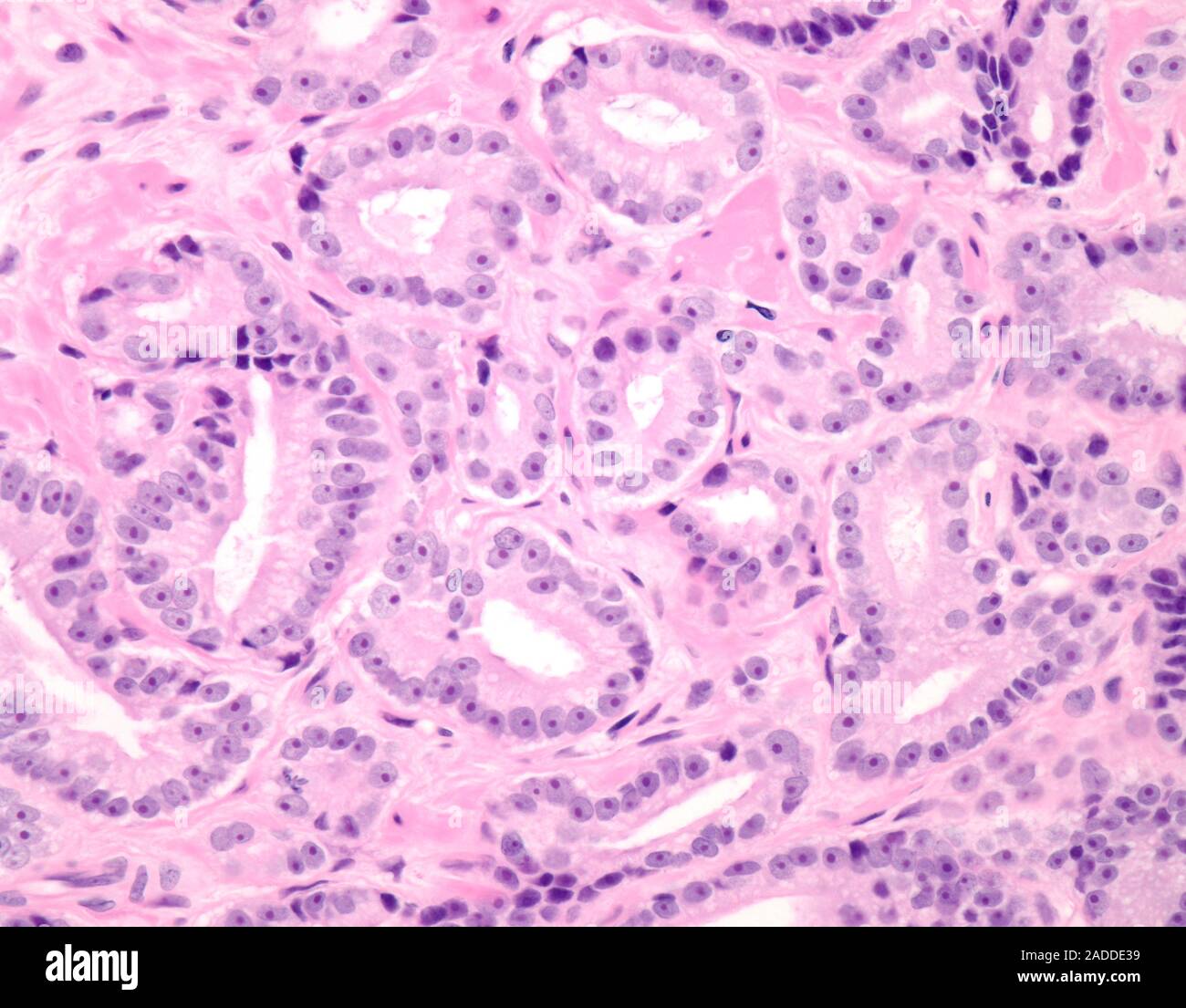 Light micrograph of prostate cancer from a transrectal ultrasound ...