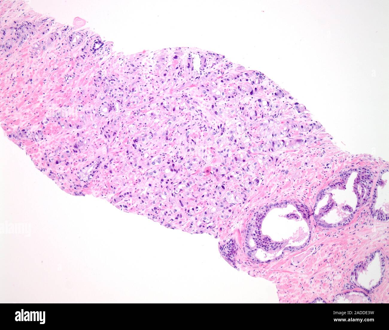 Light micrograph of prostate cancer from a needle biopsy. This is a ...