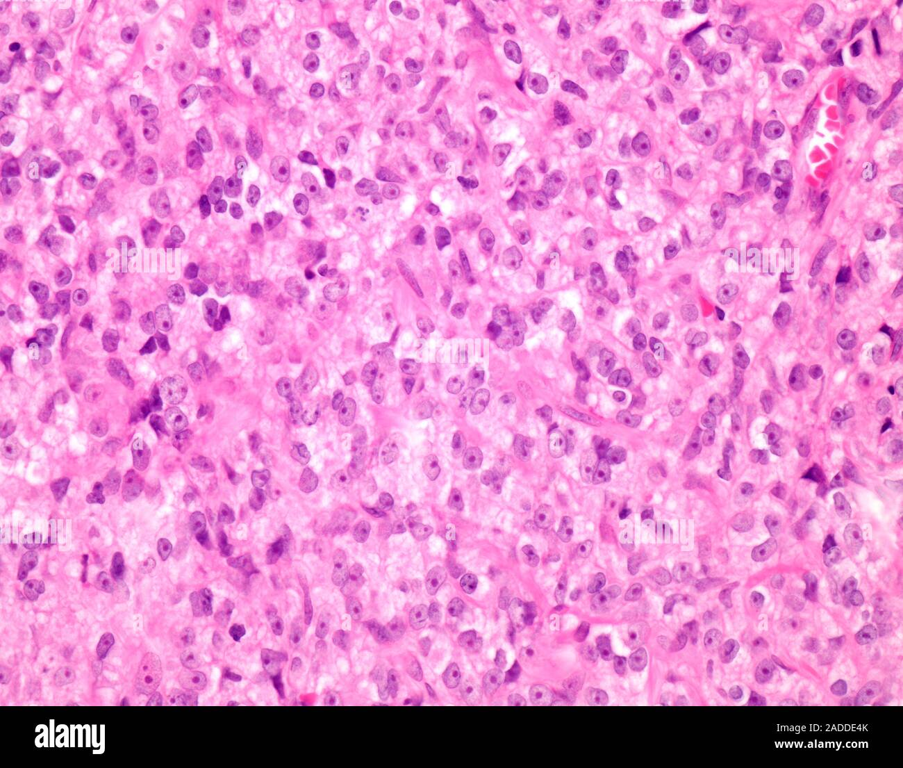 Light micrograph of prostate cancer. This is a high-grade (aggressive ...