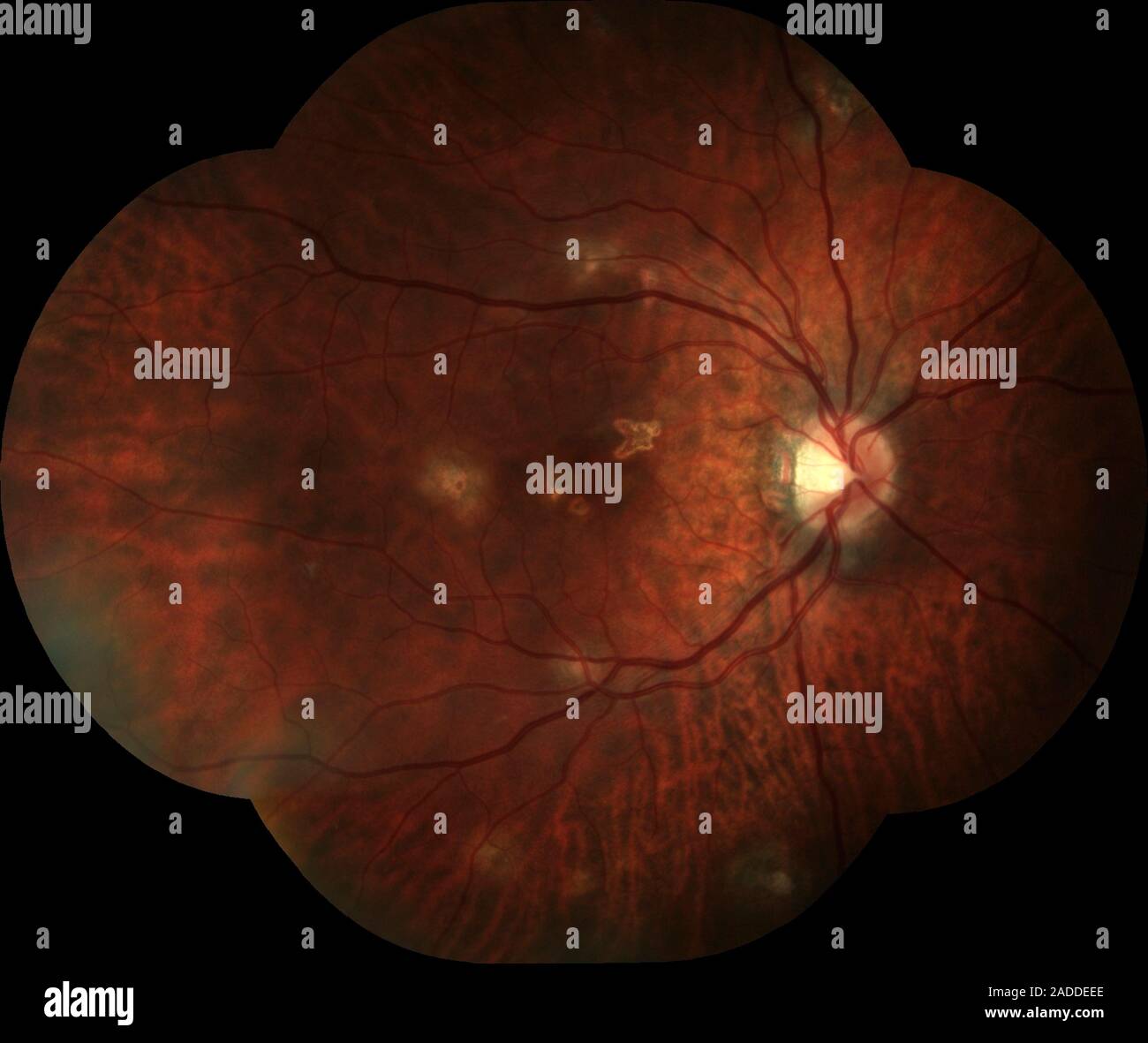 Choroiditis. Fundoscopy image of the retina of 20-year-old man's eye in ...