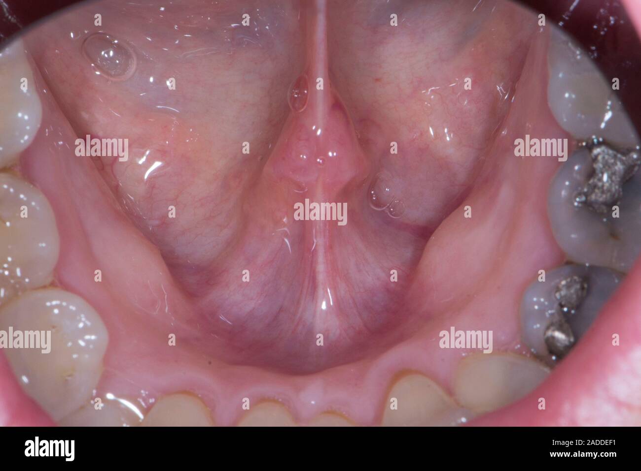 Torus Palatinus Close Up Of The Floor Of The Mouth Of A 48 Year Old Woman With Torus Palatinus