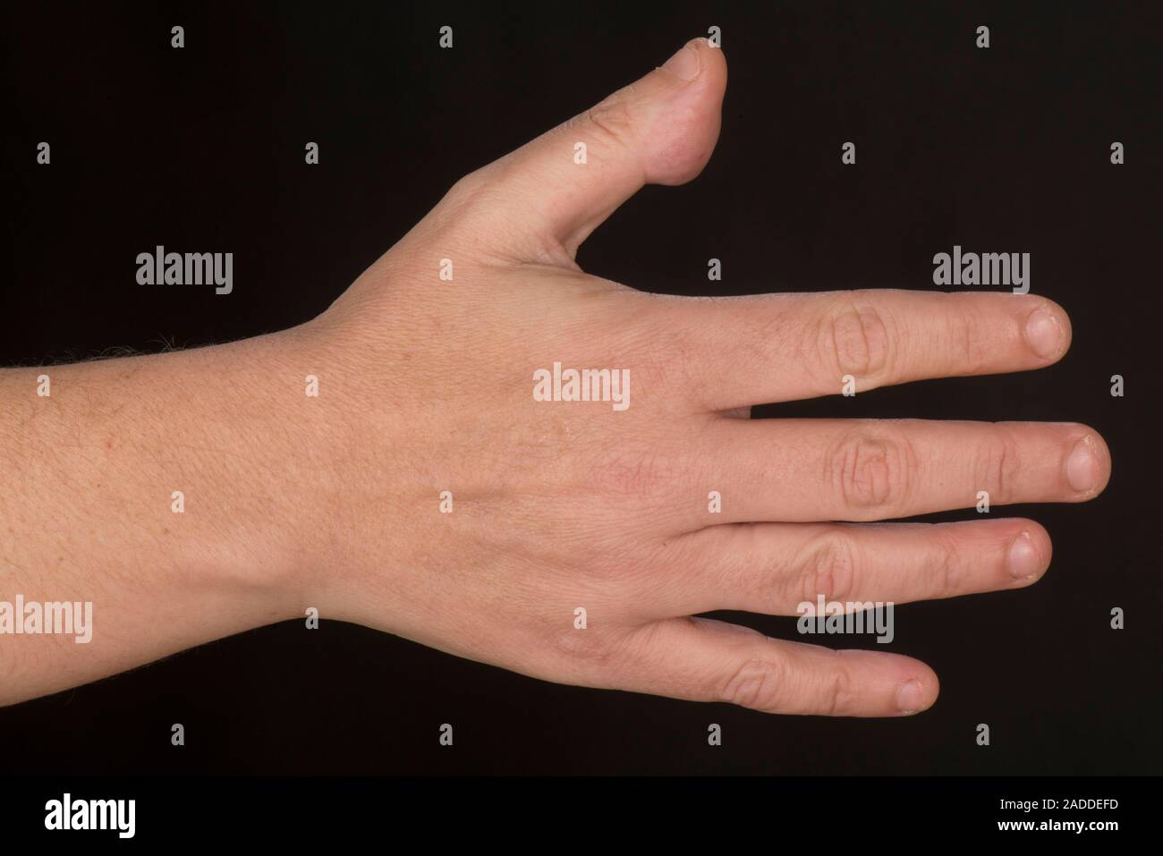 Hidradenitis suppurativa of the thumb. Close-up of a sore, inflamed and ...