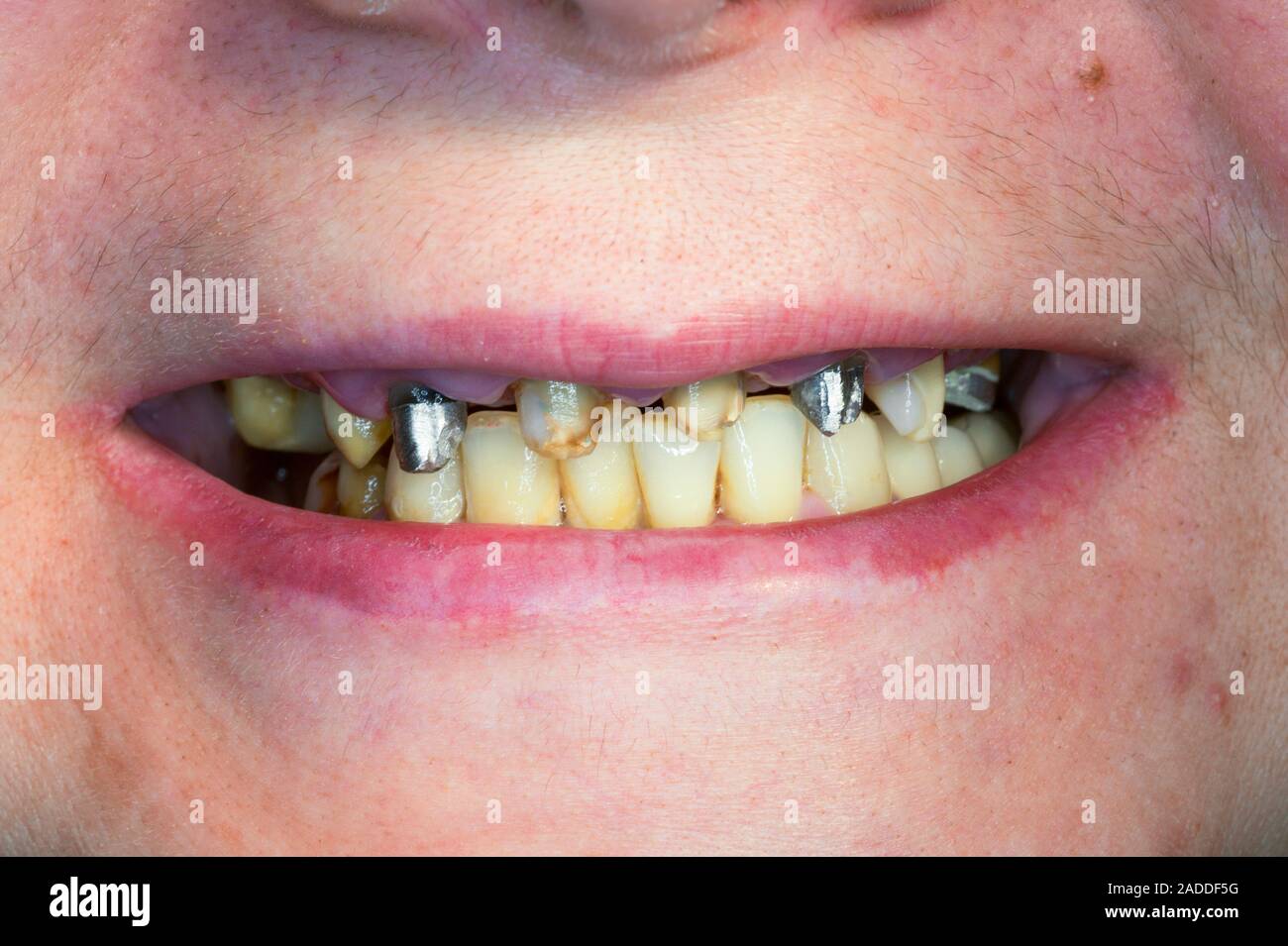 Teeth prepared for dental crowns. Close-up of the upper teeth of a 55 ...