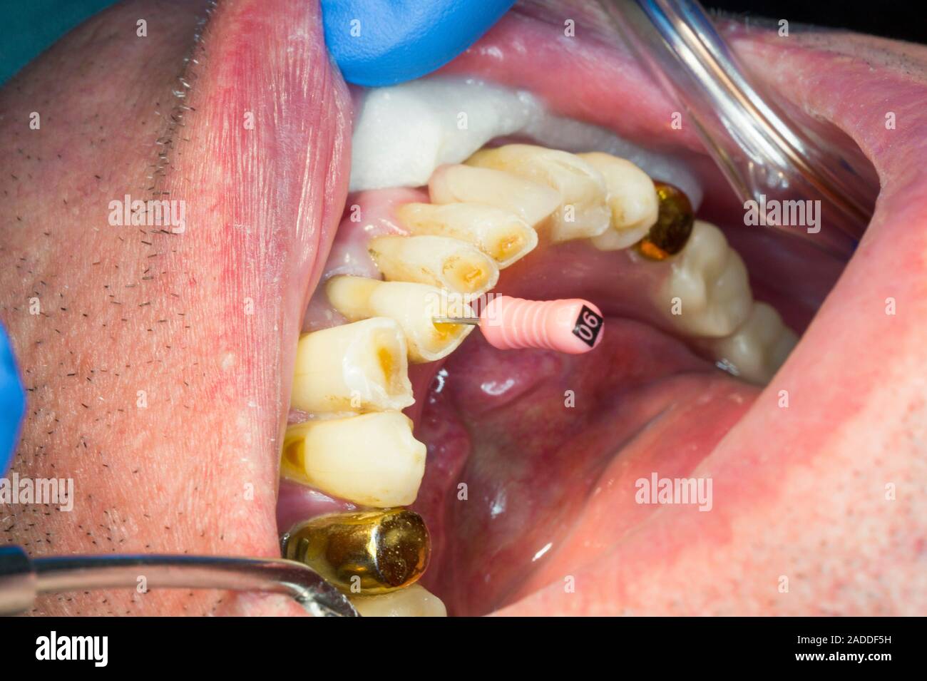 Mouth of a patient undergoing root canal surgery to treat tooth decay ...