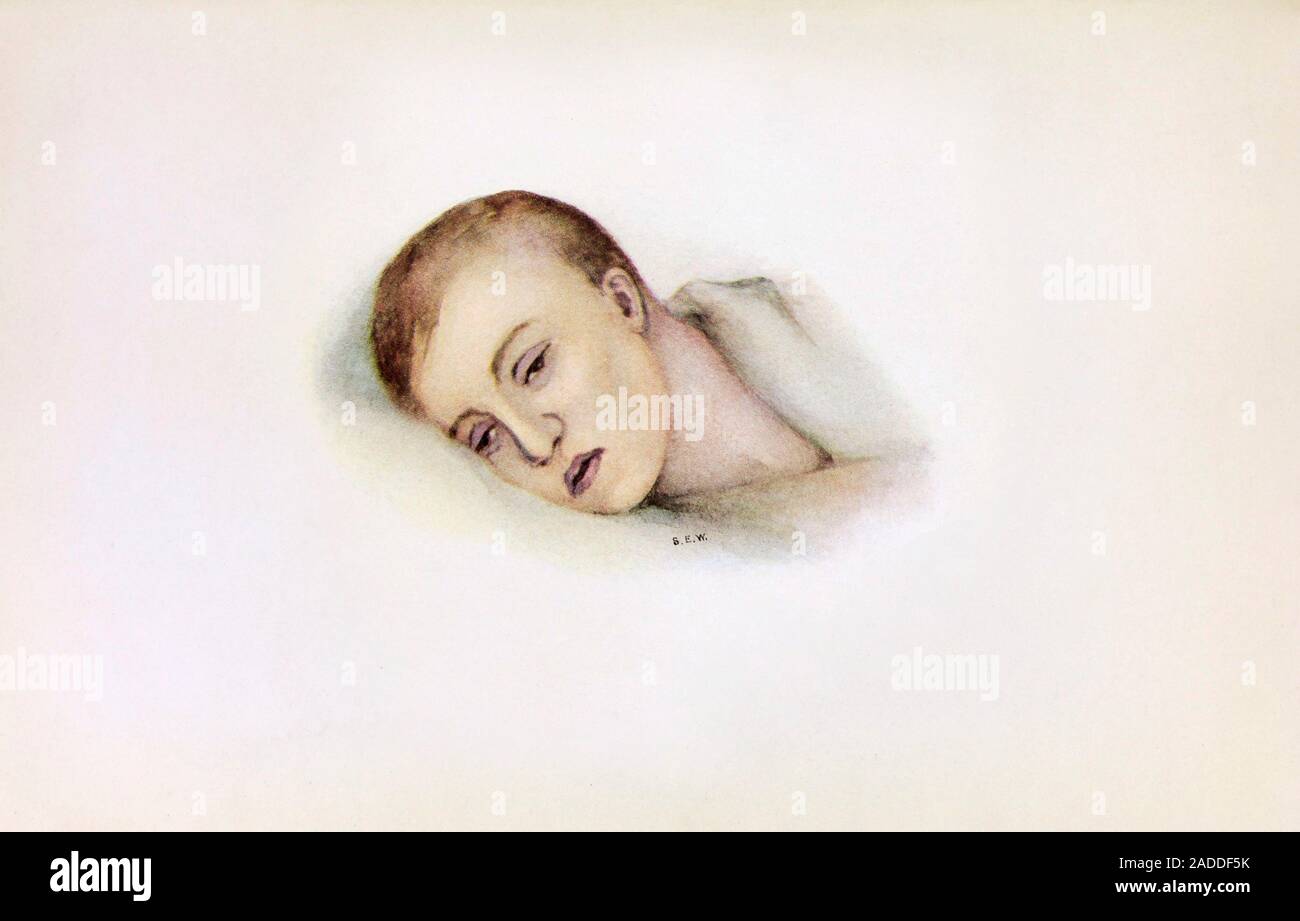 Illustration of a Spanish influenza patient with cyanosis of the head ...