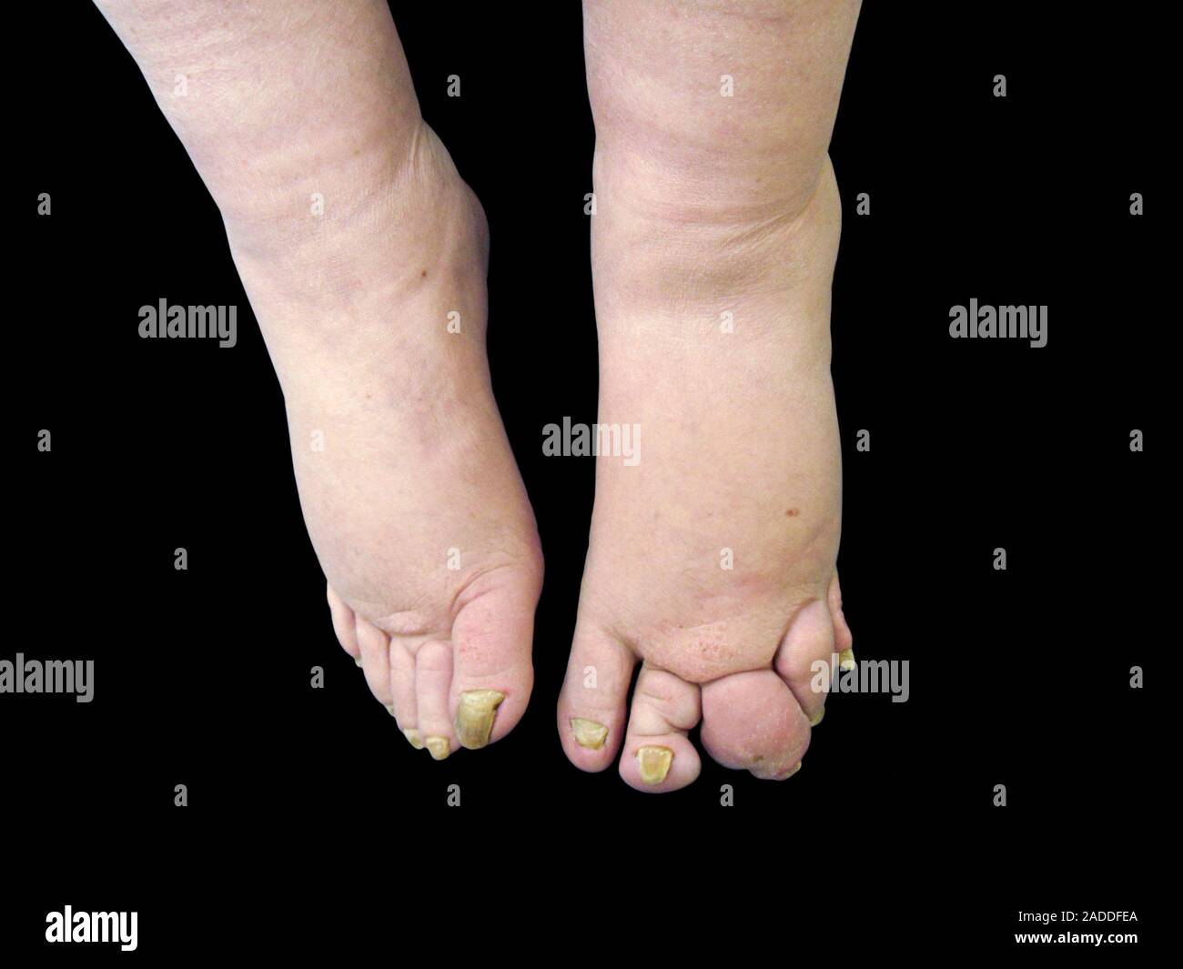 Macrodactyly of the feet. Close-up of the feet of a 45-year-old woman ...