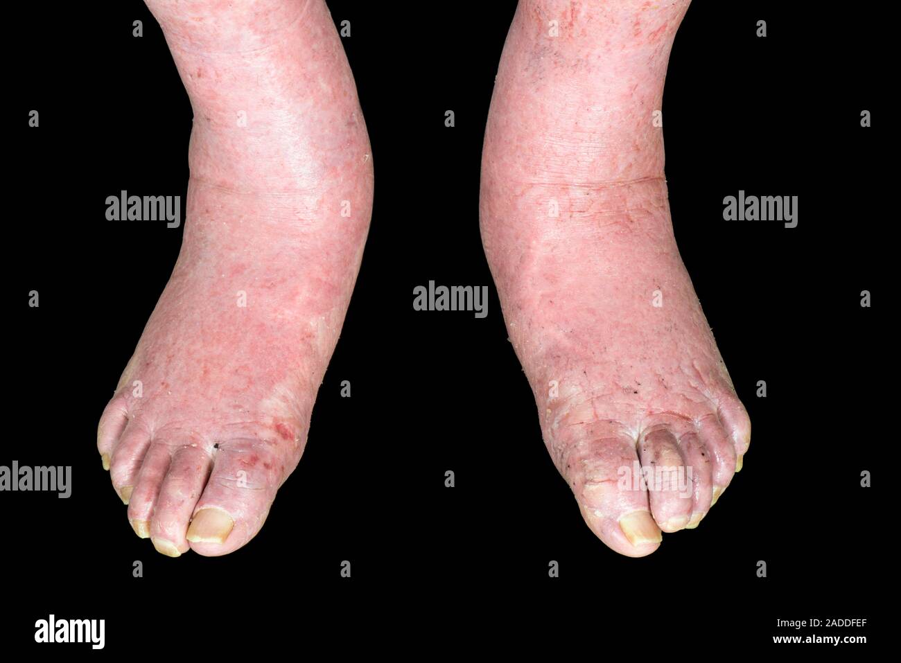 Foot ulcers on the skin of an 83-year-old woman. An ulcer is an open ...