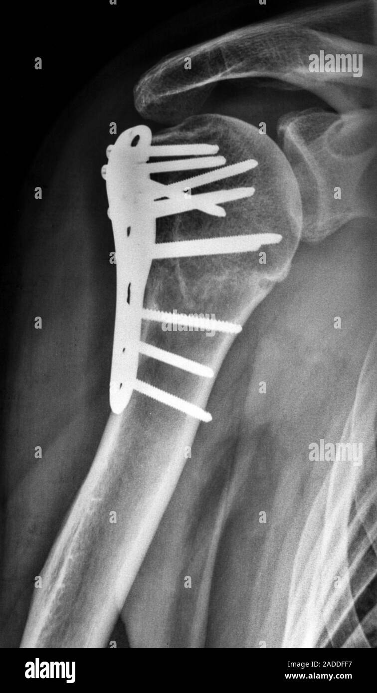 X-ray of a humerus (upper arm bone) that has been fixed to repair a ...