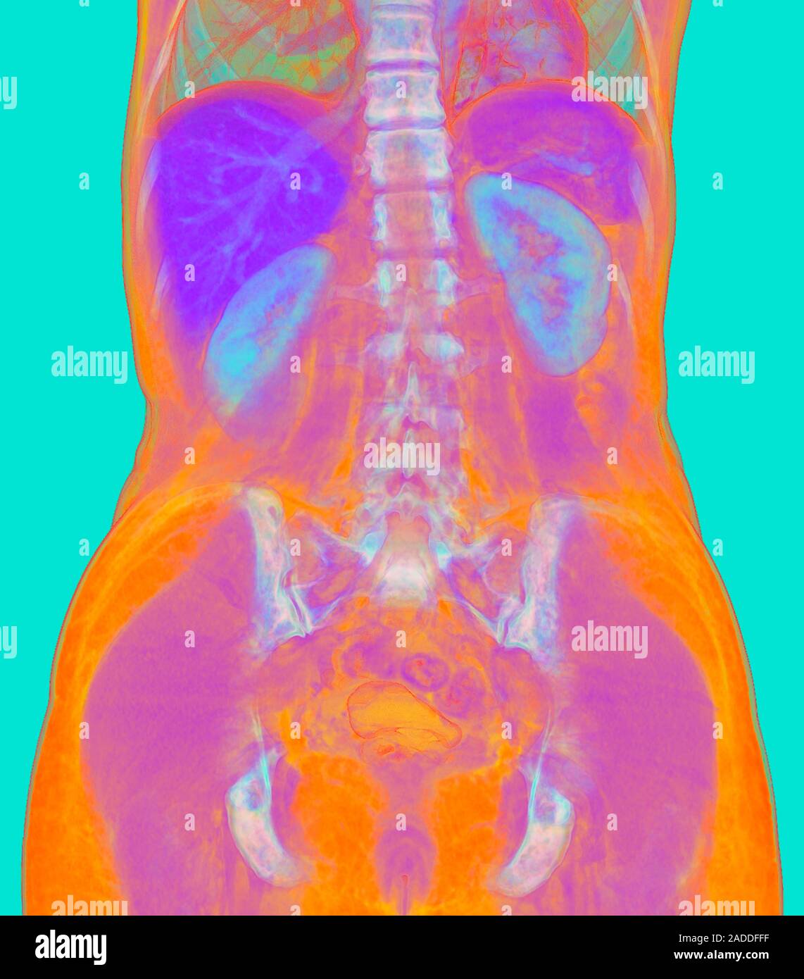 Abdomen and pelvis, coloured coronal magnetic resonance imaging (MRI ...