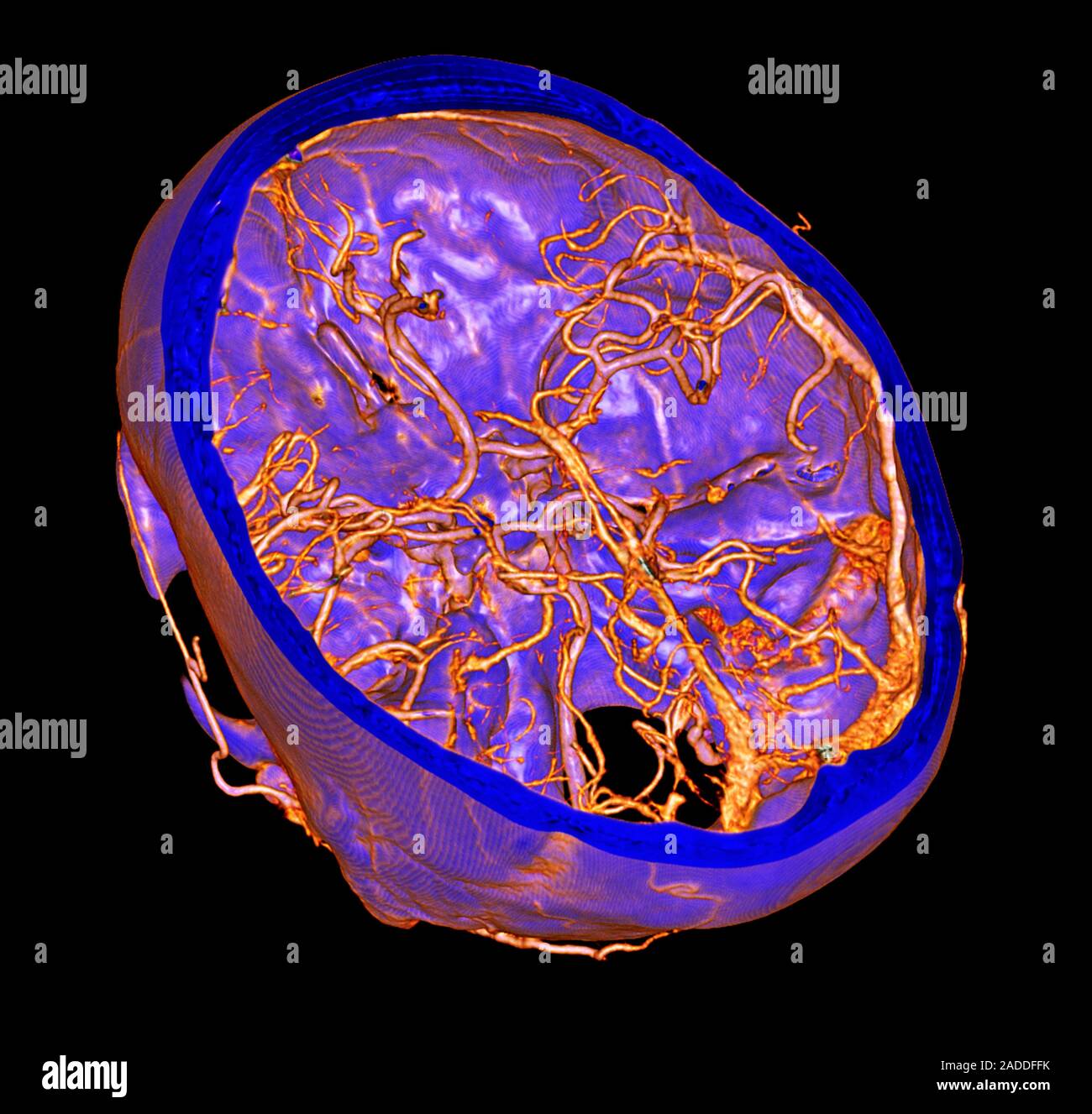 Intracranial blood vessels. Coloured 3D computed tomography (CT) scan of a human brain and the ...