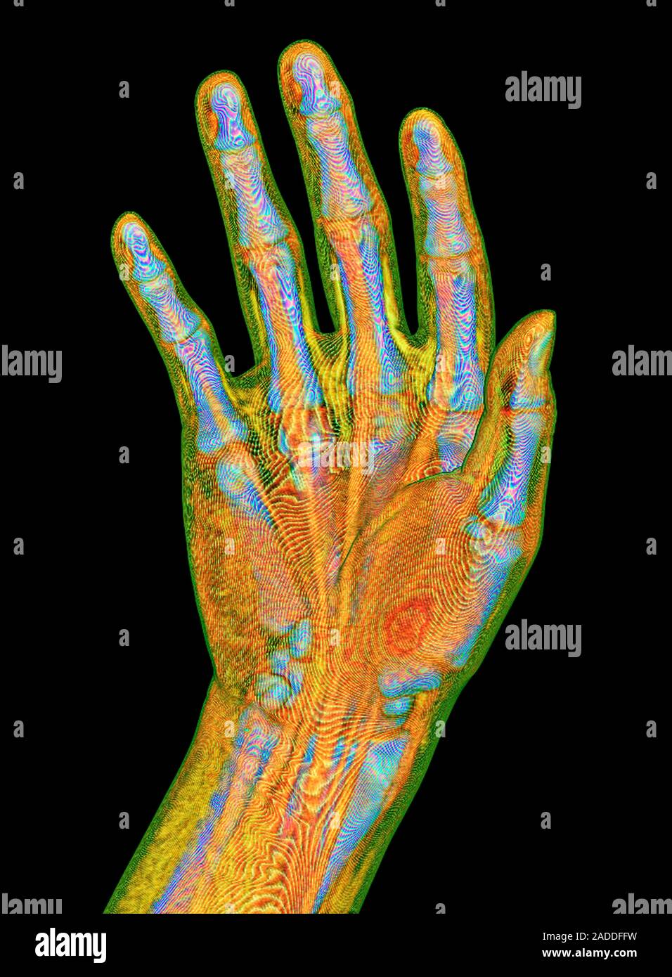 Human hand, 3D coloured computed tomography (CT) scan. This view of the ...